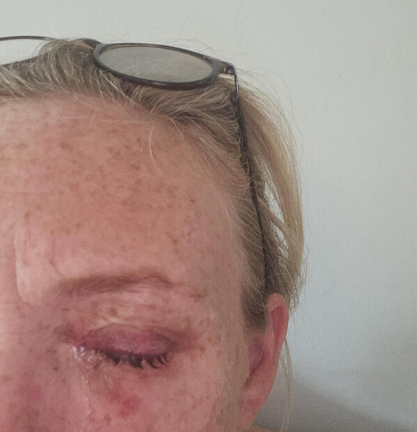 ‘I wouldn’t wish this on anyone’: rider’s eye sliced open in freak ...